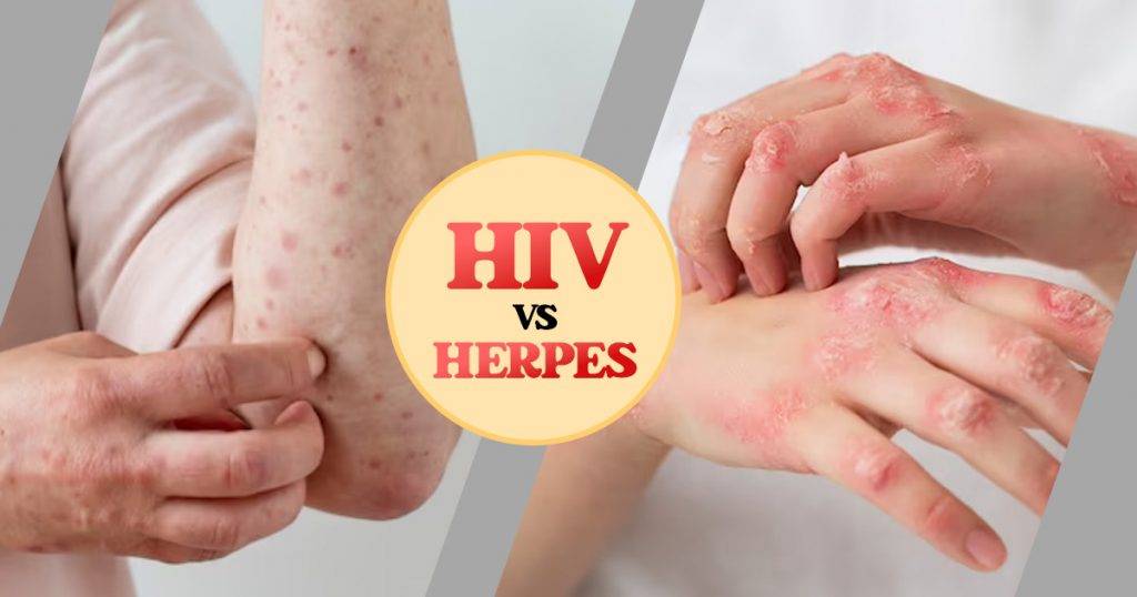 HIV vs. Herpes: Explaining Their Differences