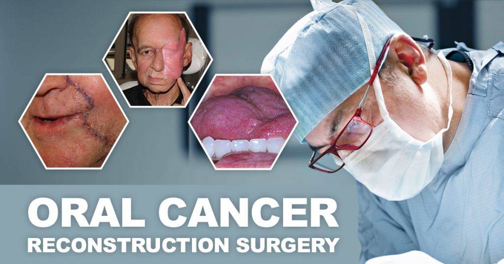 Reconstruction Surgery for Oral Cancer: What to Expect