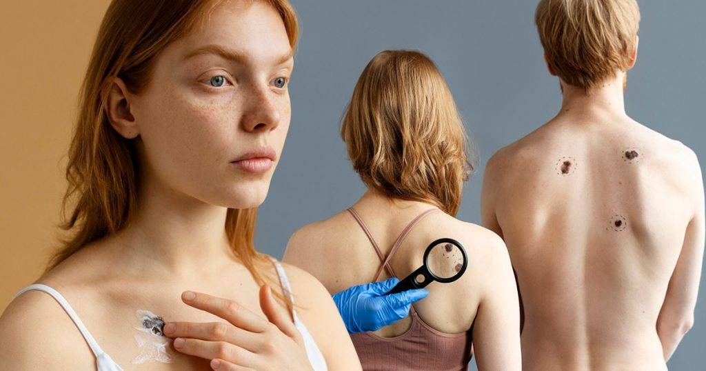 The Facts About DIY Mole Removal