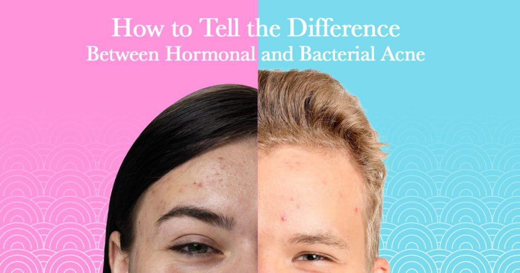 Hormonal vs Bacterial Acne: How to Identify & Treat It